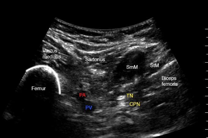 [정형외과 전문의] 하지 신경차단술 (Femoral n block~ankle block etc.) : 네이버 블로그