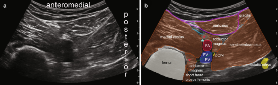 [정형외과 전문의] 하지 신경차단술 (Femoral n block~ankle block etc.) : 네이버 블로그