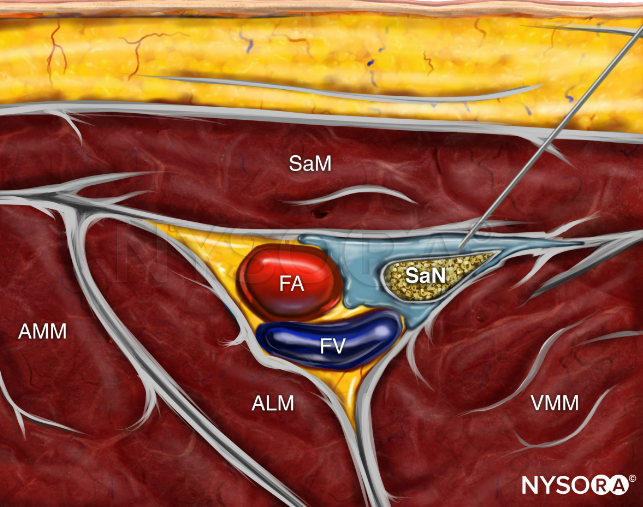 [정형외과 전문의] 하지 신경차단술 (Femoral n block~ankle block etc.) : 네이버 블로그