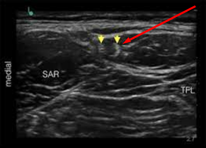 [정형외과 전문의] 하지 신경차단술 (Femoral n block~ankle block etc.) : 네이버 블로그