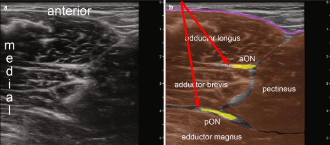 [정형외과 전문의] 하지 신경차단술 (Femoral n block~ankle block etc.) : 네이버 블로그
