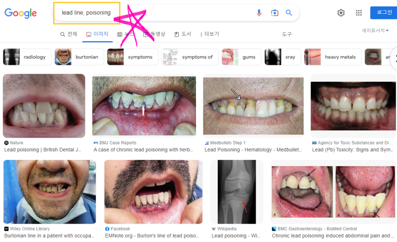 납중독 증상, 징후, 진단 : 네이버 블로그