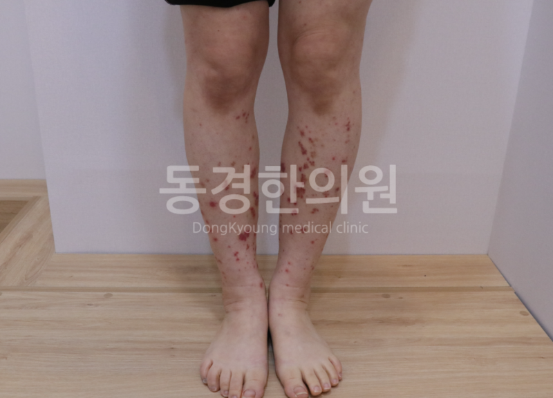 연령별 자반증의 원인과 증상 소아성인노인자반증 네이버 블로그