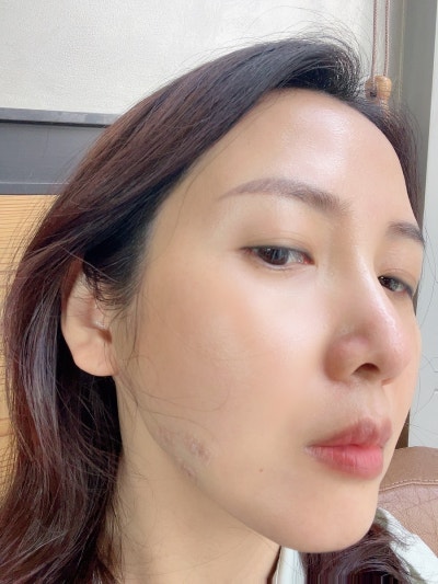 얼굴 실리프팅 팔자주름 펴진 후기 실리프팅 가격 실리프팅 통증 붓기 실리프팅 내돈내산 미친v리프팅 네이버 블로그