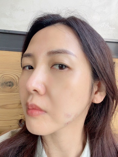 얼굴 실리프팅 팔자주름 펴진 후기 실리프팅 가격 실리프팅 통증 붓기 실리프팅 내돈내산 미친v리프팅 네이버 블로그