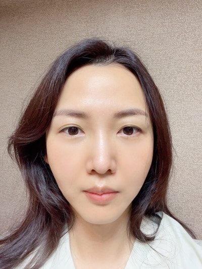 얼굴 실리프팅 팔자주름 펴진 후기 실리프팅 가격 실리프팅 통증 붓기 실리프팅 내돈내산 미친v리프팅 네이버 블로그