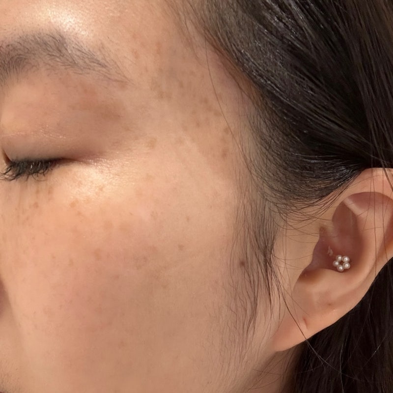압구정 피부과 30대 피부관리 피부 흑자 피코슈어 토닝스펙트라 기미잡티제거 1회차 후기 네이버 블로그