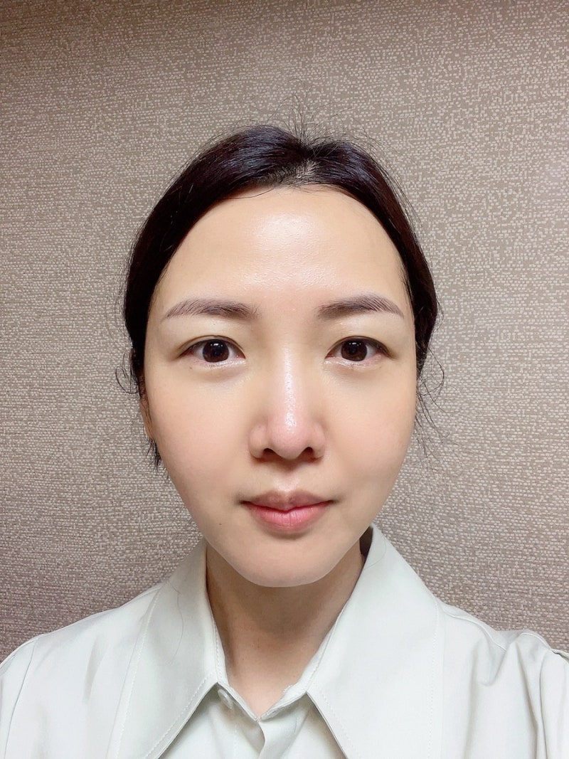 얼굴 실리프팅 팔자주름 펴진 후기 실리프팅 가격 실리프팅 통증 붓기 실리프팅 내돈내산 미친v리프팅 네이버 블로그