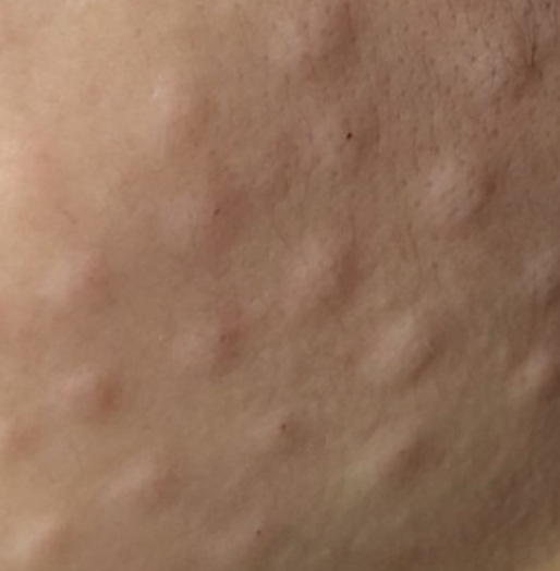 스킨보톡스더마톡신 Vs 보톡스 차이 알고 맞기 효과 부작용 주기 통증 후기 대백과사전 네이버 블로그