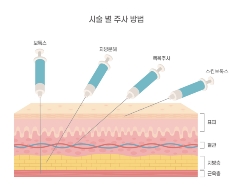 스킨보톡스더마톡신 Vs 보톡스 차이 알고 맞기 효과 부작용 주기 통증 후기 대백과사전 네이버 블로그