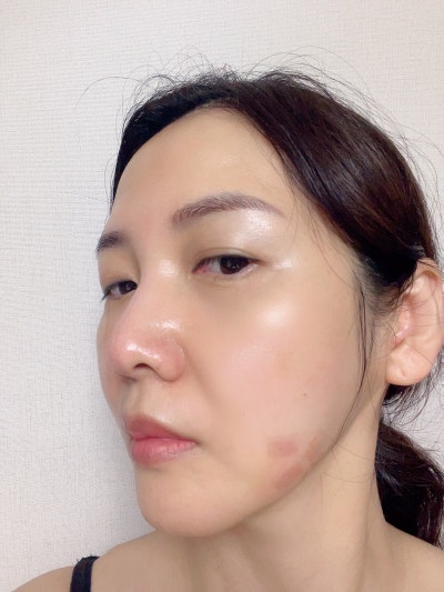 얼굴 실리프팅 팔자주름 펴진 후기 실리프팅 가격 실리프팅 통증 붓기 실리프팅 내돈내산 미친v리프팅 네이버 블로그