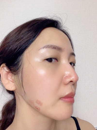 얼굴 실리프팅 팔자주름 펴진 후기 실리프팅 가격 실리프팅 통증 붓기 실리프팅 내돈내산 미친v리프팅 네이버 블로그