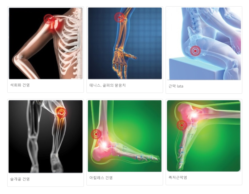 Zeus Wave Eswt 충격체외충격파치료방법충격파치료기비수술치료충격파효과 네이버 블로그