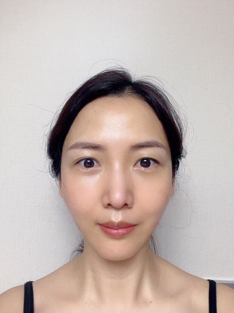 얼굴 실리프팅 팔자주름 펴진 후기 실리프팅 가격 실리프팅 통증 붓기 실리프팅 내돈내산 미친v리프팅 네이버 블로그