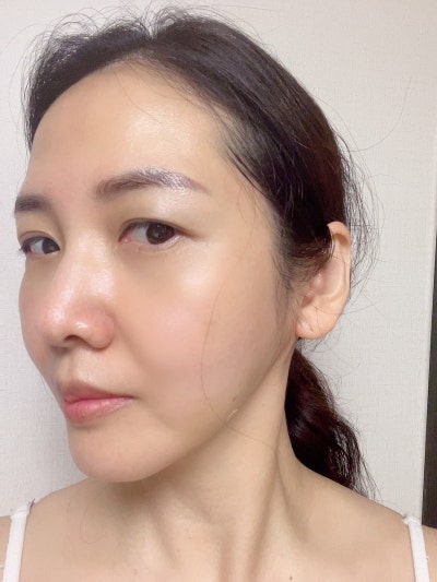 얼굴 실리프팅 팔자주름 펴진 후기 실리프팅 가격 실리프팅 통증 붓기 실리프팅 내돈내산 미친v리프팅 네이버 블로그