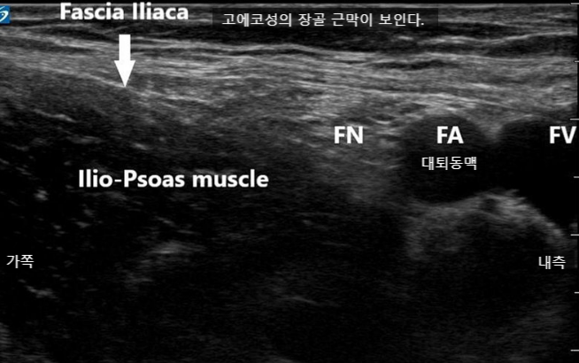 Fascia iliaca compartment block에 대한 모든 것 : 3-1 block : 네이버 블로그