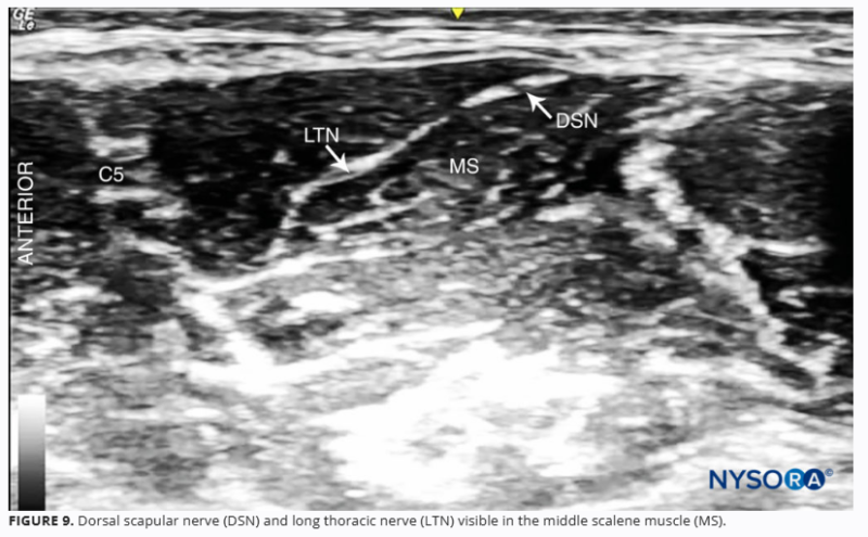 [정형외과 전문의] Brachial plexus block (Interscalene, supraclavicular ...