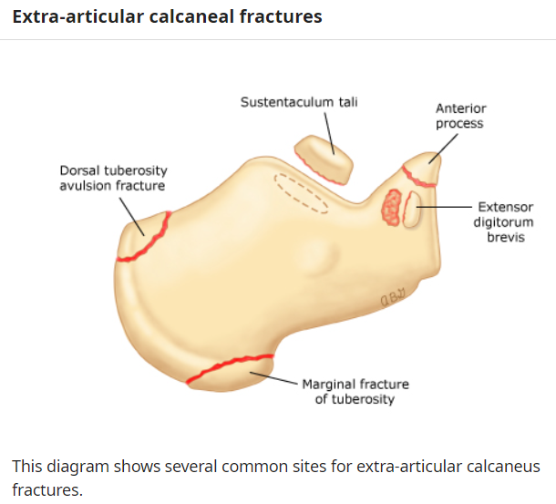 Calcaneous Fracture (종골 골절, 발꿈치뼈 골절) : 네이버 블로그
