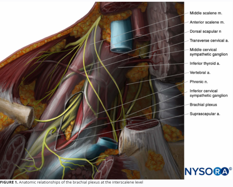 [정형외과 전문의] Brachial plexus block (Interscalene, supraclavicular ...