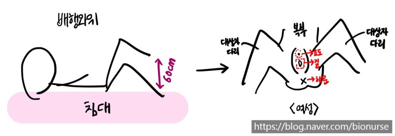 핵심 술기 유치도뇨 술기대사 네이버 블로그