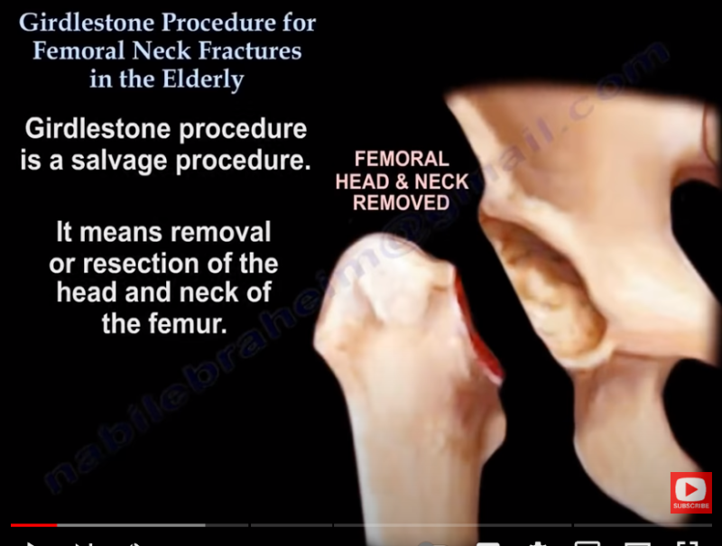 2023 05 05 Girdlestone arthroplasty : 네이버 블로그