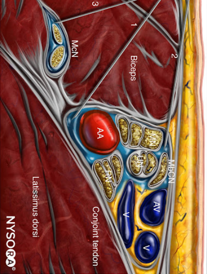 [정형외과 전문의] Brachial plexus block (Interscalene, supraclavicular ...