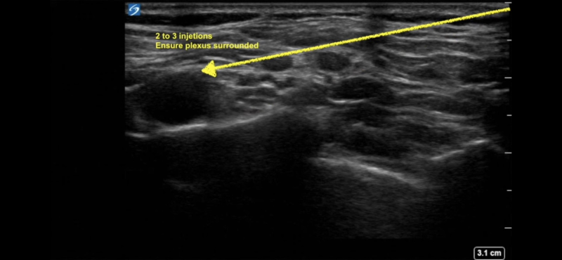 [정형외과 전문의] Brachial plexus block (Interscalene, supraclavicular ...