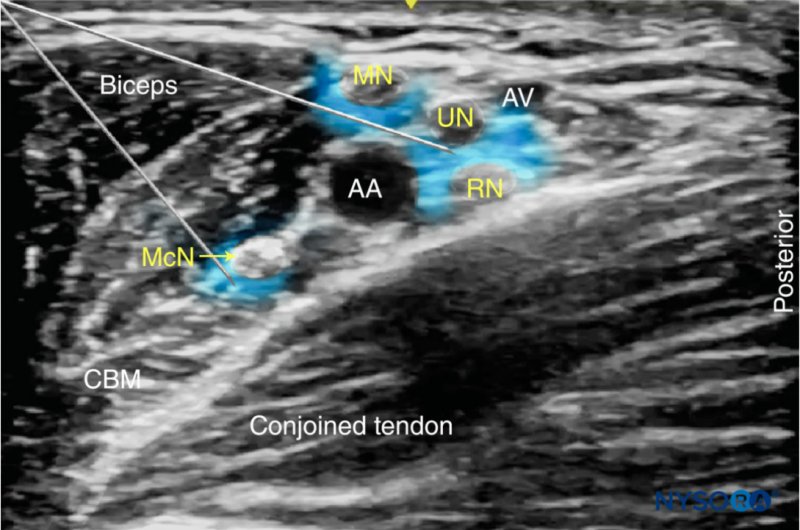 [정형외과 전문의] Brachial plexus block (Interscalene, supraclavicular ...