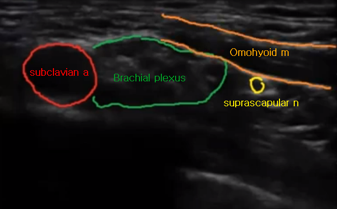 [정형외과 전문의] Brachial plexus block (Interscalene, supraclavicular ...