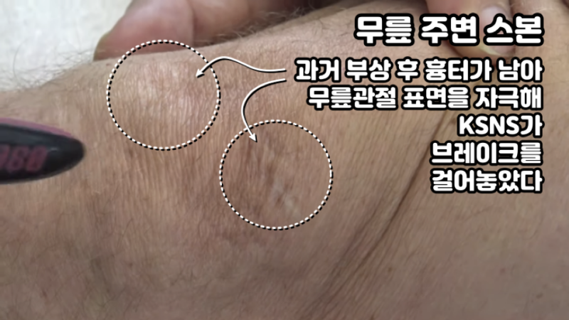 323. 30년 무릎 고관절 통증 무릎 흉터 KSNS KSS 스본 스도 30분 후 100% 개선 : 네이버 블로그