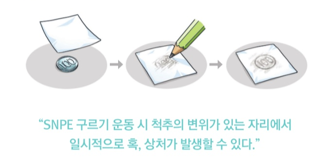 [SNPE] FAQ : 구르기 운동 후 꼬리뼈가 까지고, 상처가 생겼어요. : 네이버 블로그