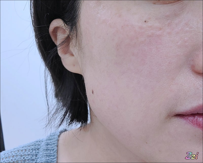 구월동 피부과 리쥬란힐러 얇은피부 2cc 시술 후기 통증 효과 가격 네이버 블로그