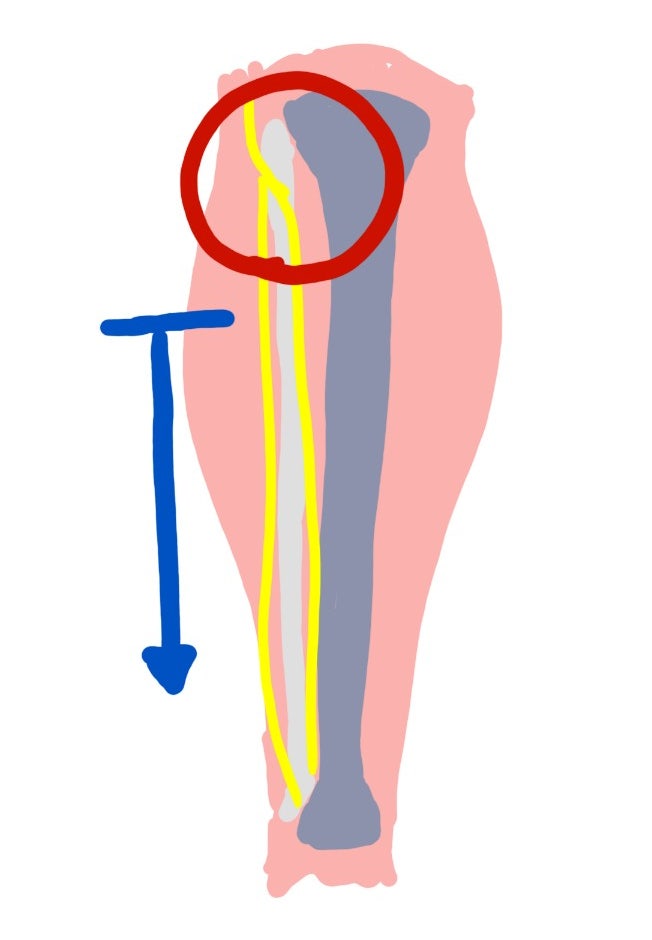 ankle fracture 발목 골절 short leg splint (SLS) 하는법과 주의점 : 네이버 블로그