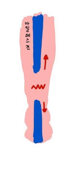 ankle fracture 발목 골절 short leg splint (SLS) 하는법과 주의점 : 네이버 블로그
