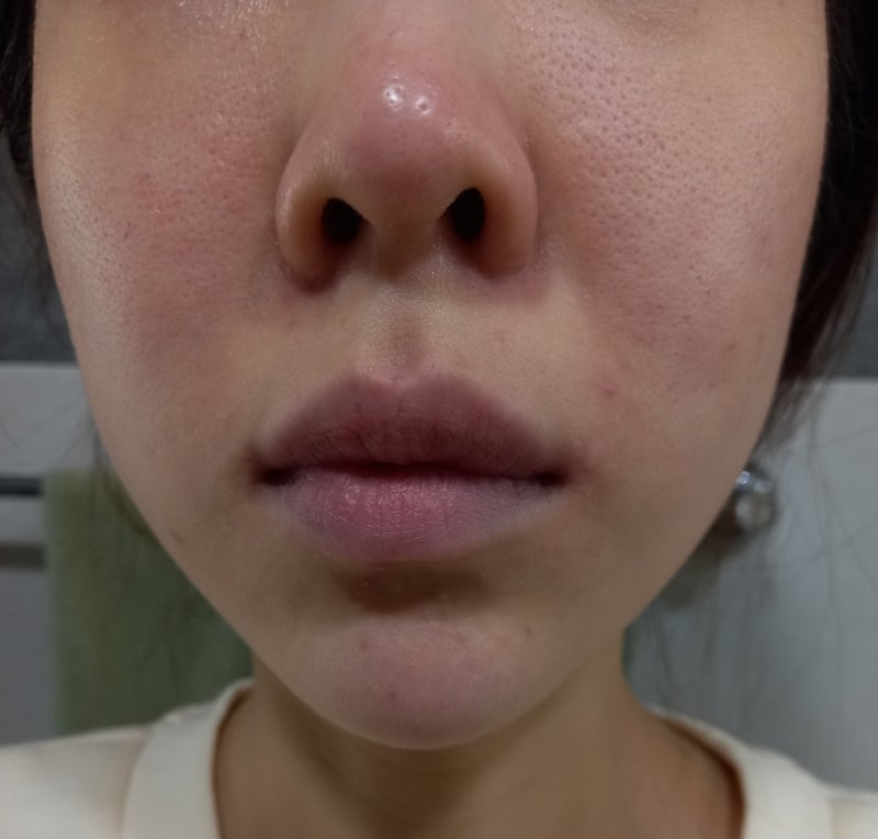 구월동 피부과 리쥬란 효과 솔직후기 부작용 통증 신부관리 추천 이유 네이버 블로그