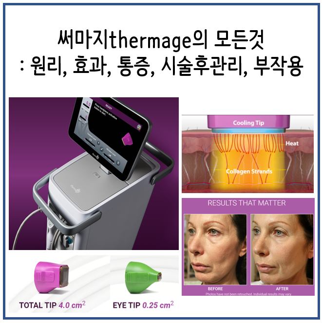 [고주파장비1] 써마지(Thermage)의 모든것 :: 원리, 효과, 통증, 시술후관리, 부작용 : 네이버 블로그