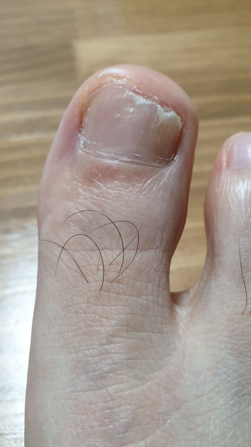 발톱무좀 치료후기 완치 보고서 네이버 블로그