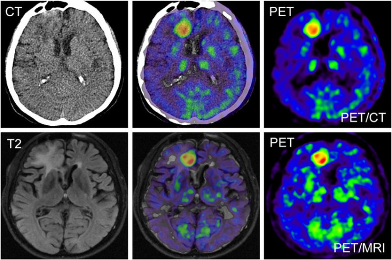 CT, MRI, PET 차이점 (CT, MRI, PET, What’s the difference?) : 네이버 블로그