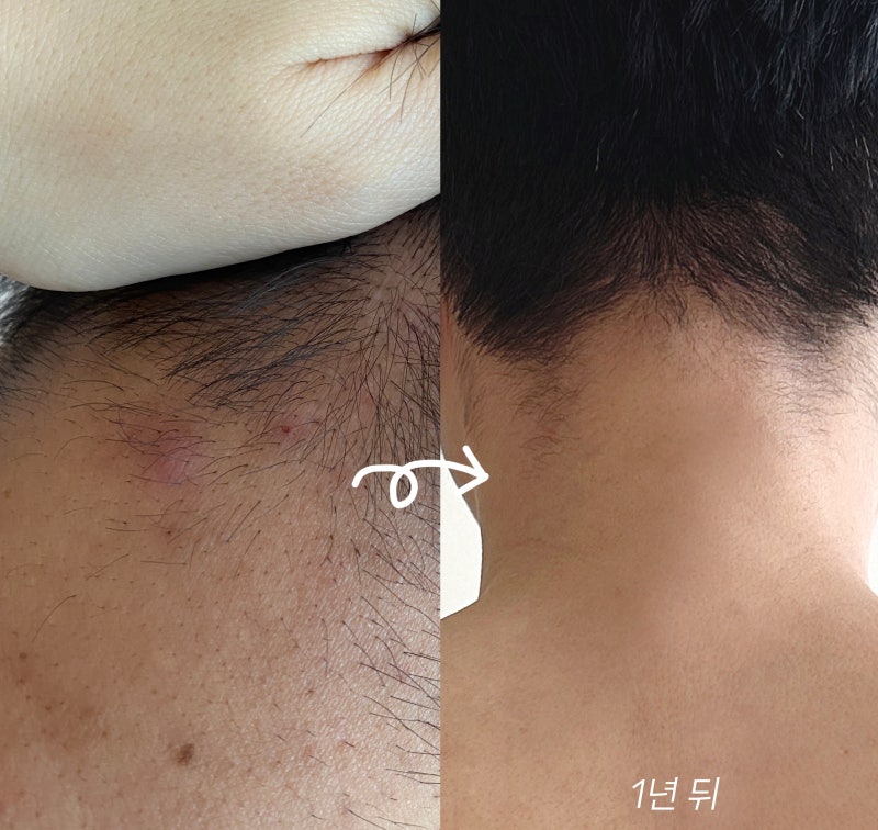 지루성 두피염 증상 원인 And 1년 셀프 치료 후기 두피 여드름 니조랄 노비프록스 세비프록스 샴푸 두피앤 네이버 블로그
