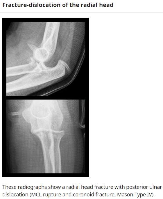 Radial head and neck fracture (요골두 요골 경부 골절) : 네이버 블로그