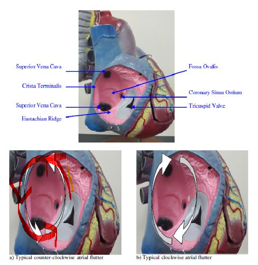 심방조동 분류 : Cavo-tricuspid isthmus (CTI)-dependent atrial flutter와 Non ...
