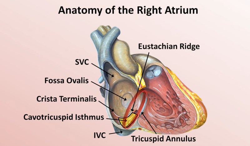 심방조동 분류 : Cavo-tricuspid isthmus (CTI)-dependent atrial flutter와 Non ...
