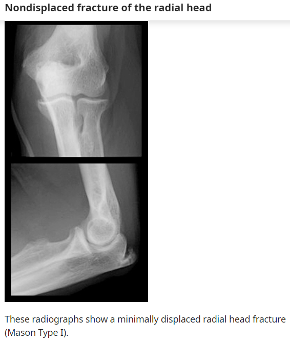 Radial head and neck fracture (요골두 요골 경부 골절) : 네이버 블로그