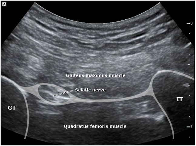 좌골 신경 차단술(Transgluteal Sciatic nerve block)에 관하여. - 좌골신경 지배 부위, 수술 적응증과 ...