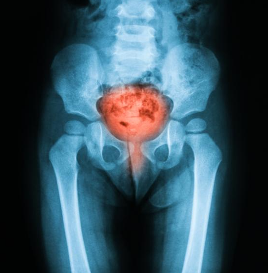 간질성 방광염 방광이 자꾸 아파요 간질성방광염 증상치료원인블래드케어이아루릴빈뇨절박뇨급박뇨배뇨통방광통증증후군