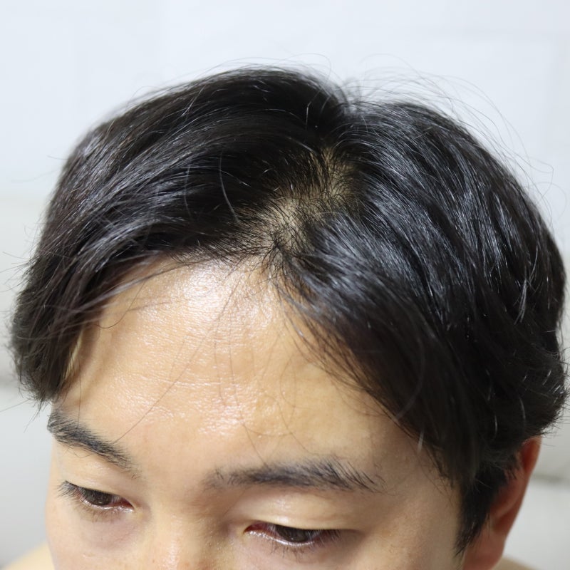 지성 두피 천연샴푸추천 닥터올가 스칼프 비듬 머리 속 뾰루지 지루성 두피염 각질관리와 냄새 제거 네이버 블로그