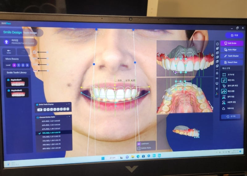 레이 페이스 2(RayFace 200) 디지털 덴티스트리 3D Face Scanner 레이페이스2 설치 작동 3D 안면스캐너 ...