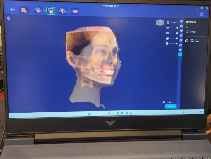 레이 페이스 2(RayFace 200) 디지털 덴티스트리 3D Face Scanner 레이페이스2 설치 작동 3D 안면스캐너 ...