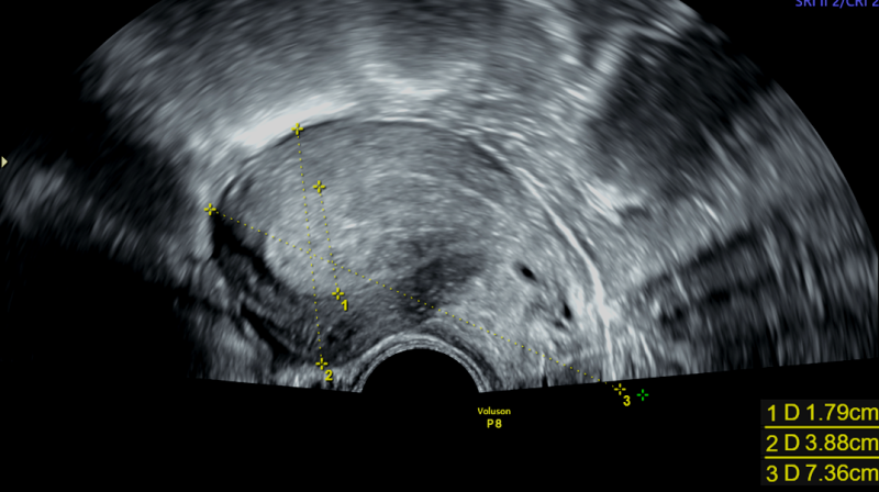 자궁내막 증식증이 무엇인가요 Endometrial Hyperplasia 네이버 블로그