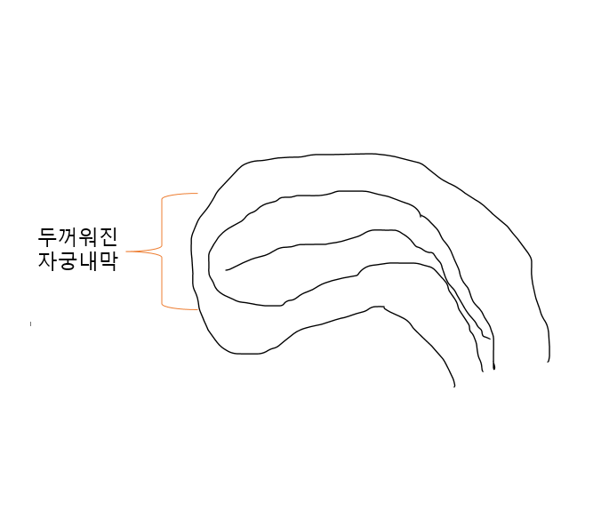 자궁내막 증식증이 무엇인가요 Endometrial Hyperplasia 네이버 블로그
